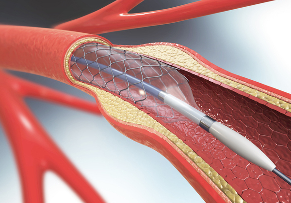 PTCA Full Form: PTCA Stands for Percutaneous Transluminal Coronary ...